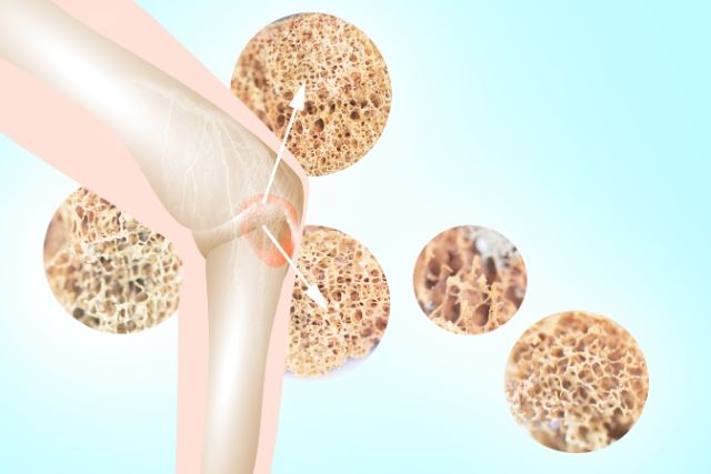 What you need to know about Osteopenia vs. Osteoporosis