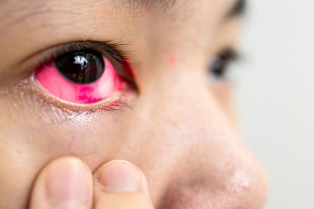 Pink eye (Conjunctivitis)