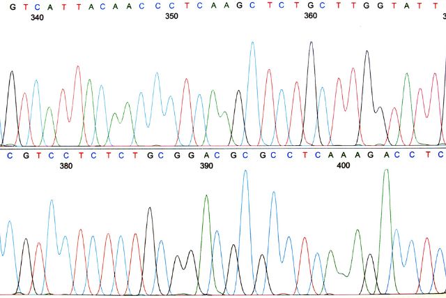 How to Interpret Peak Shapes in a Chromatogram