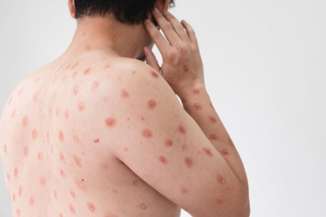 Asia Detects First Case of New Mpox Virus Strain:Thailand on High Alert